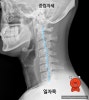 머리가 아픈데 목 때문이라고 경추성 두통 후두신경통 원인 과 바른자세 팁 네이버 블로그